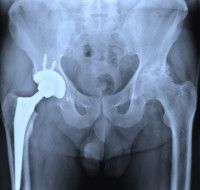 Biomet Hip Implant Lawsuits Consolidated in Indiana Federal Court
