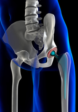 Biomet Hip Replacement Lawsuit Alleges Implant Causes Metallosis