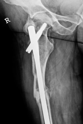 Stryker Offering Settlements to Hip Replacement Victims