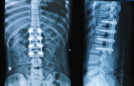 The Dangers of Off-Label Infuse Bone Graft Use