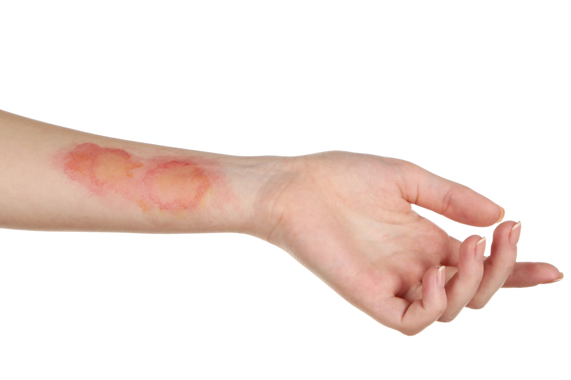 What is Cipro SJS Syndrome?
