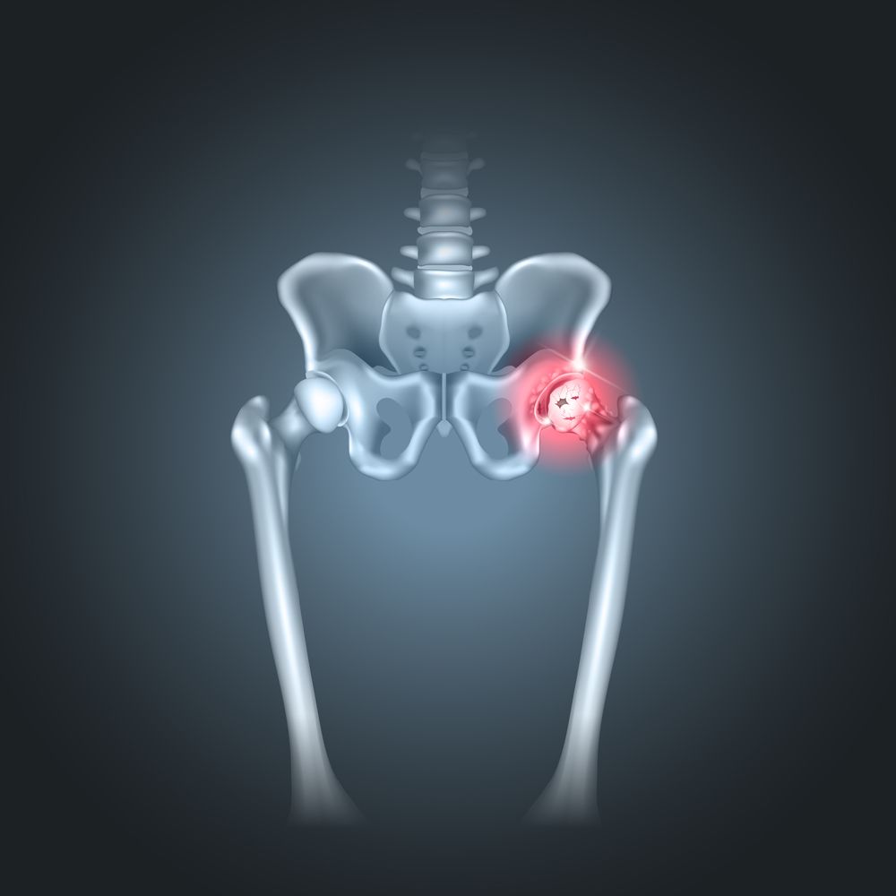 Durom Hip Implant Lawsuit Filed, Cites Extreme Pain
