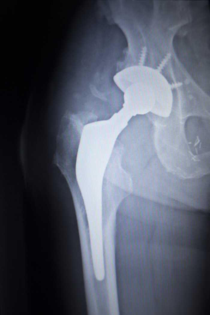 Metal-on-Metal Hip Implant Lawsuit Calls DePuy Pinnacle Defective