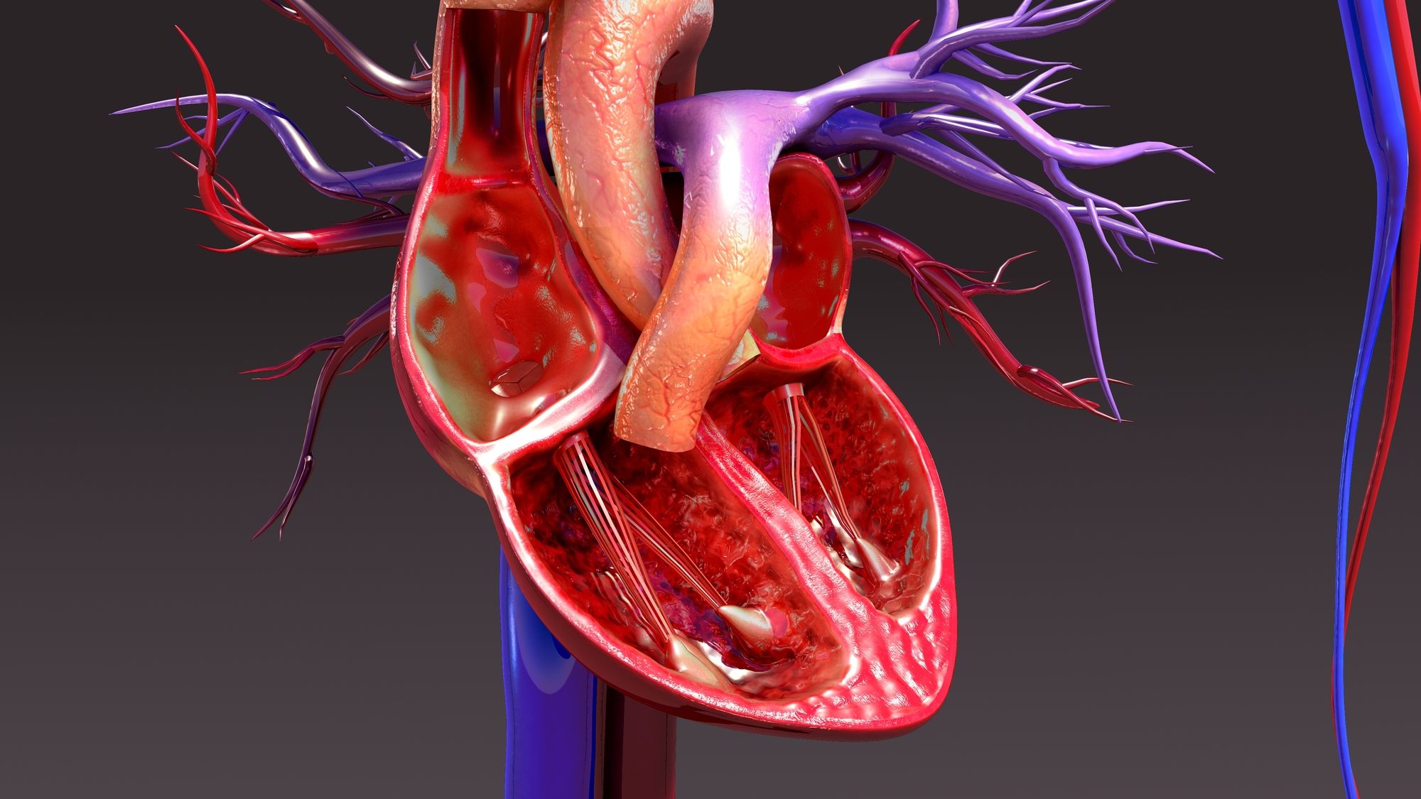 C.R. Bard Faces Another Vein Filter Lawsuit