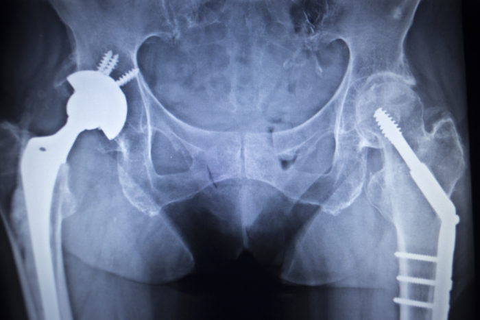 Stryker Recall of Hip Implant Sparks Lawsuits