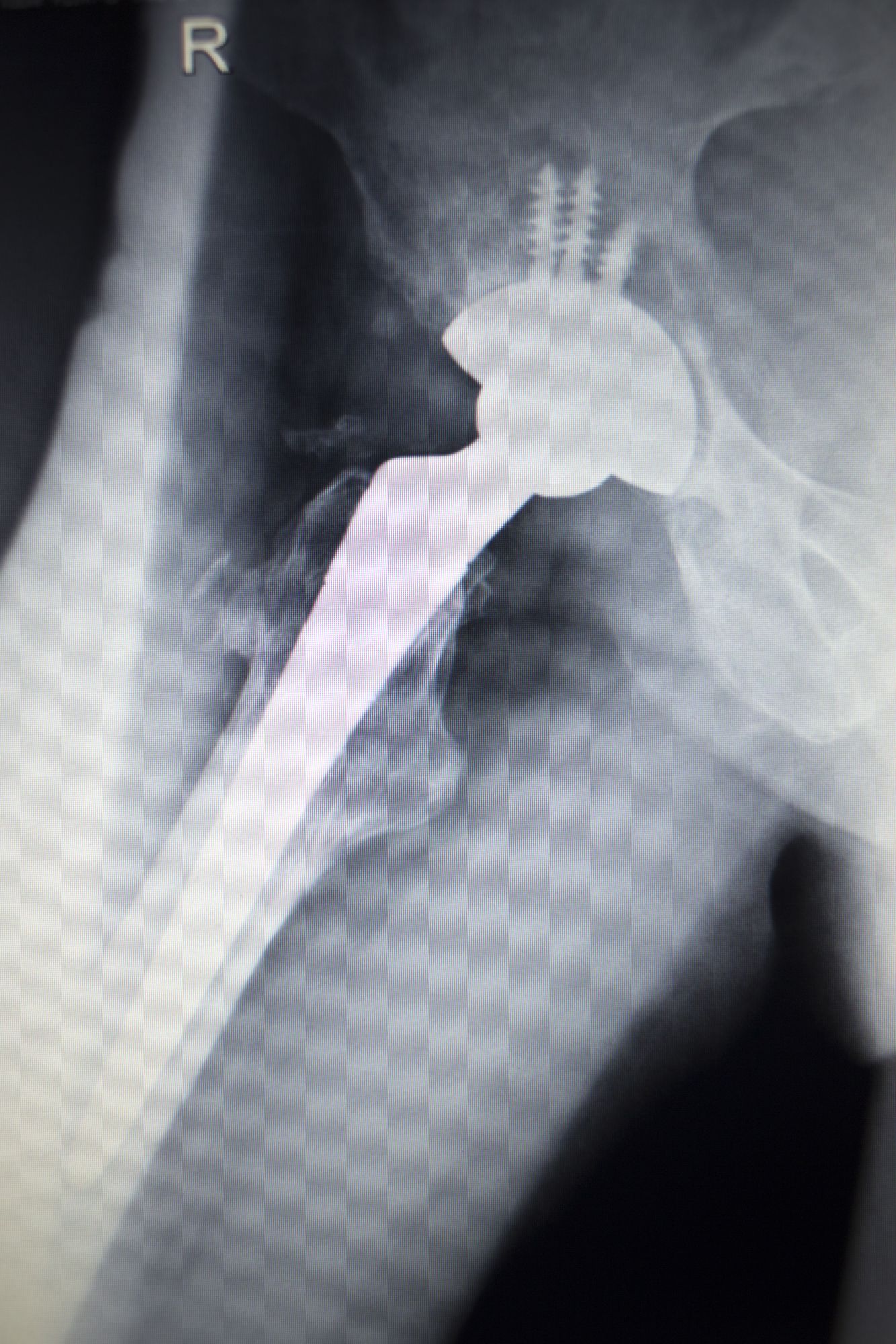 Biomet M2a Magnum Hip Implant Lawsuit Spurred by Complications