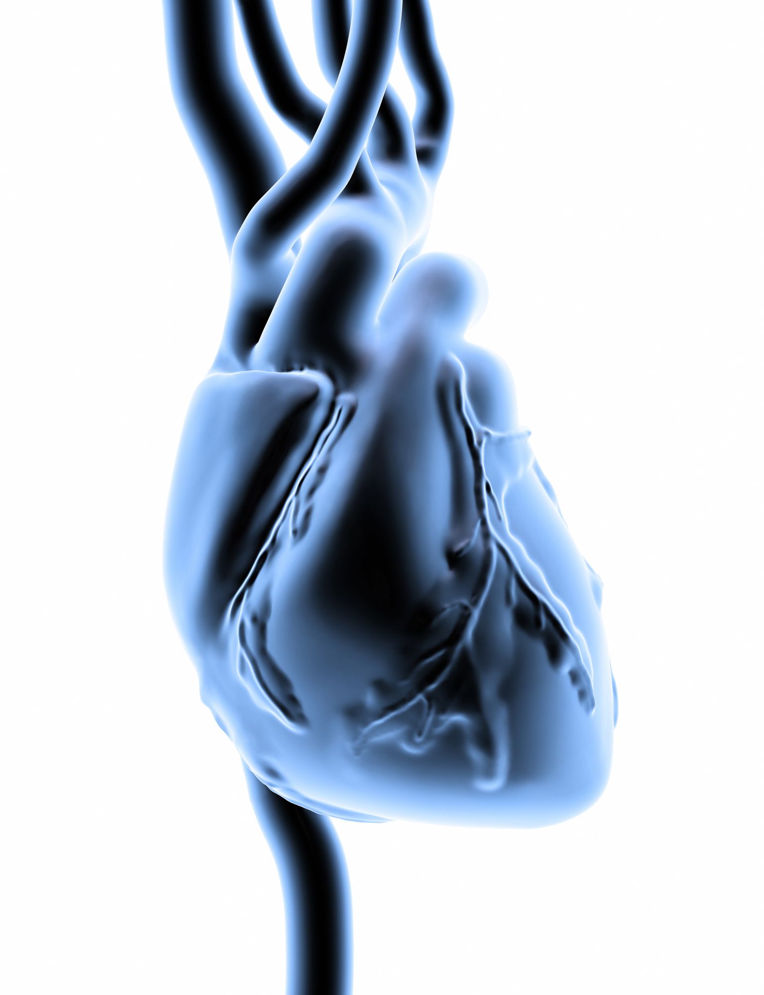 Inferior Vena Cava Filter Problems Include Organ Perforation