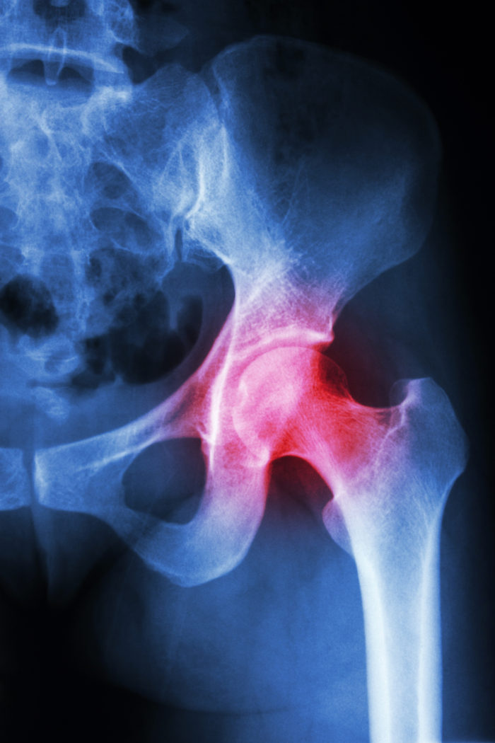 DePuy ASR Hip Settlement Open to Eligible Patients