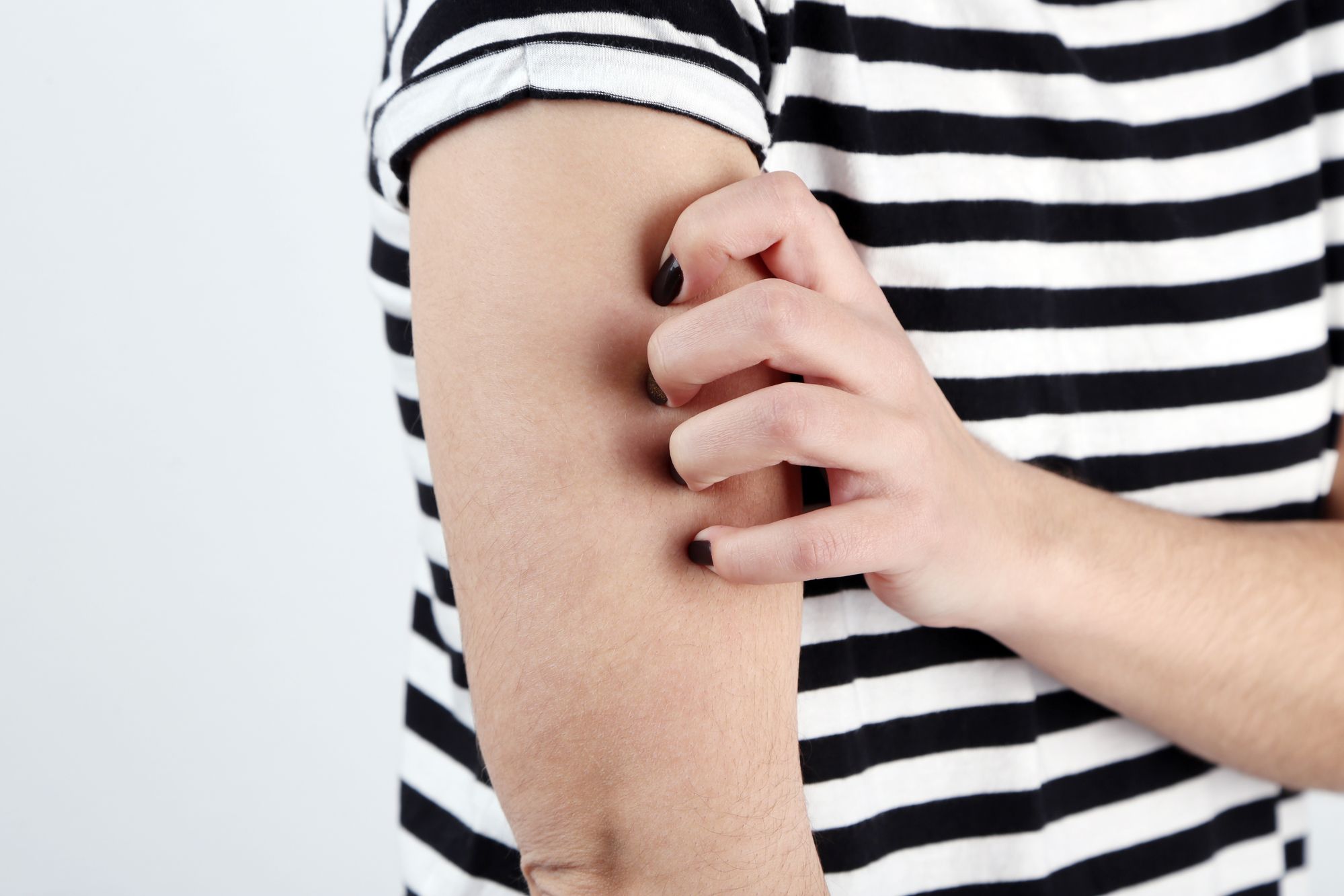 Lamictal Stevens Johnson Syndrome is a Potential Drug Side Effect