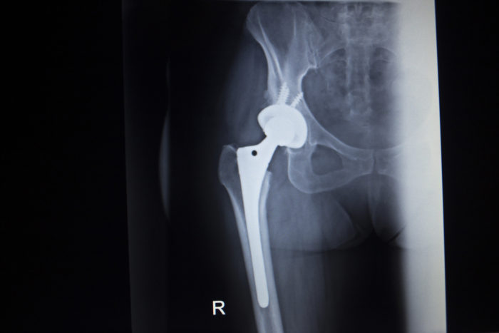 Hip Revision Surgery May Qualify for DePuy Hip Recall Compensation