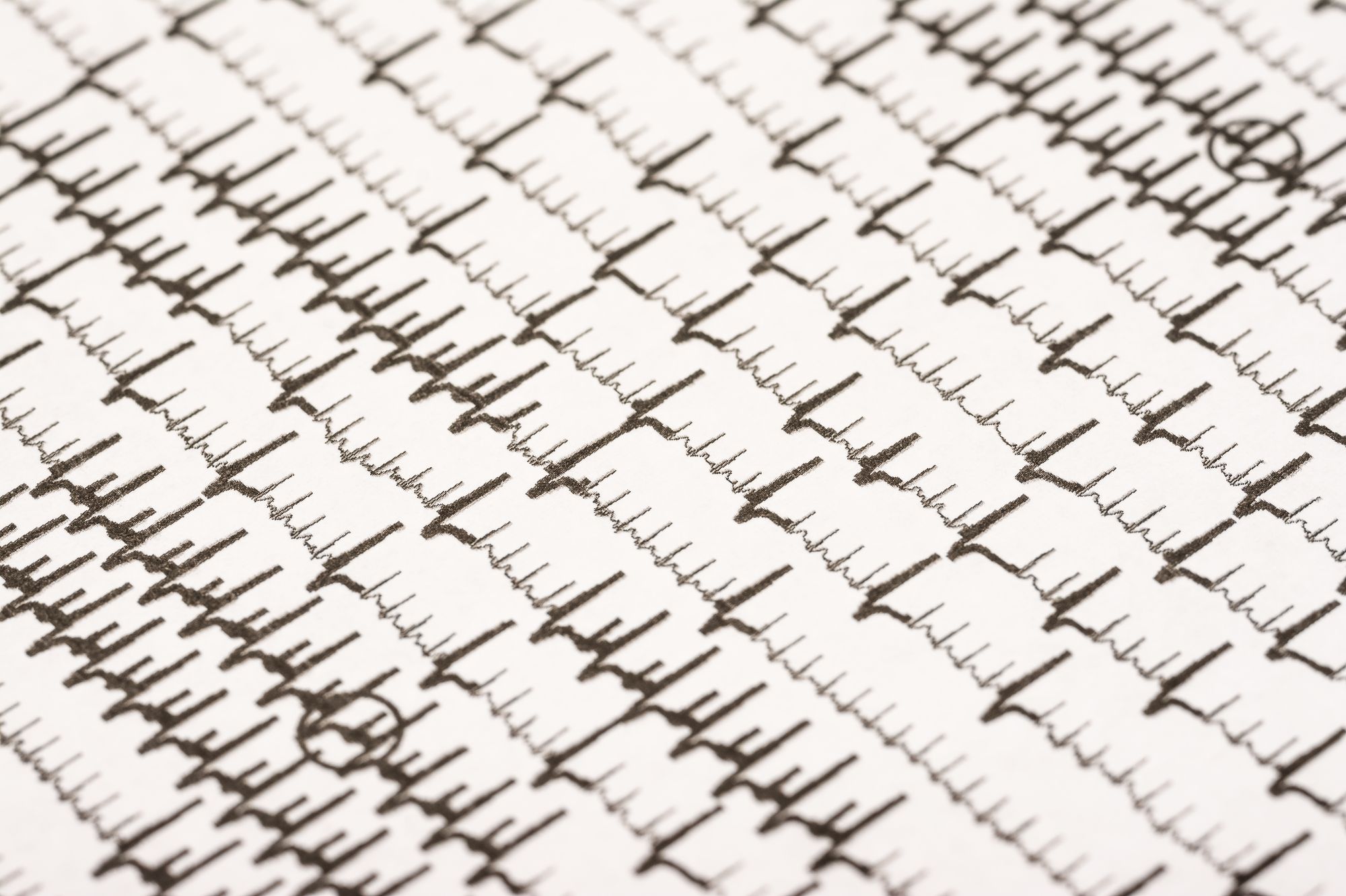 A-Fib Patients Face Risk of Pradaxa Intracranial Hemorrhage
