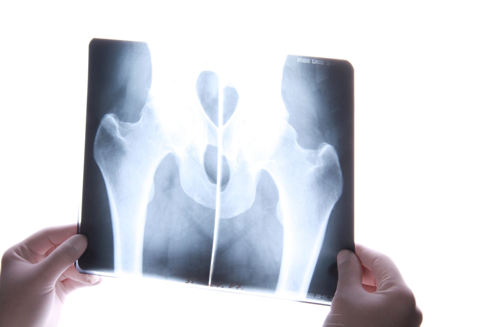 DePuy Pinnacle Hip Complications Lawsuit Filled over Early Revision