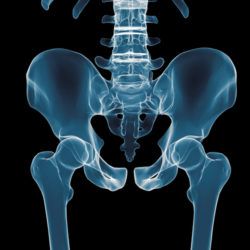 New ASR Hip Replacement Lawsuit Alleges Metal Poisoning