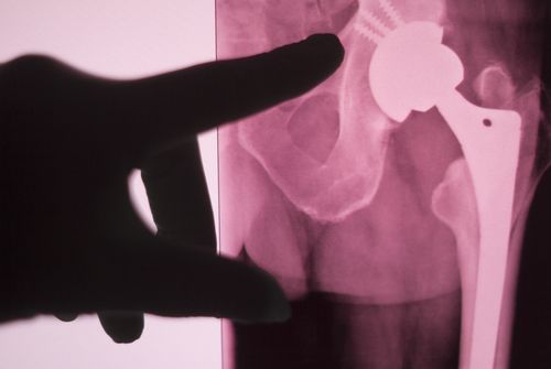 ASR Hip Replacement Settlement Reached In Canadian Class Action Lawsuit