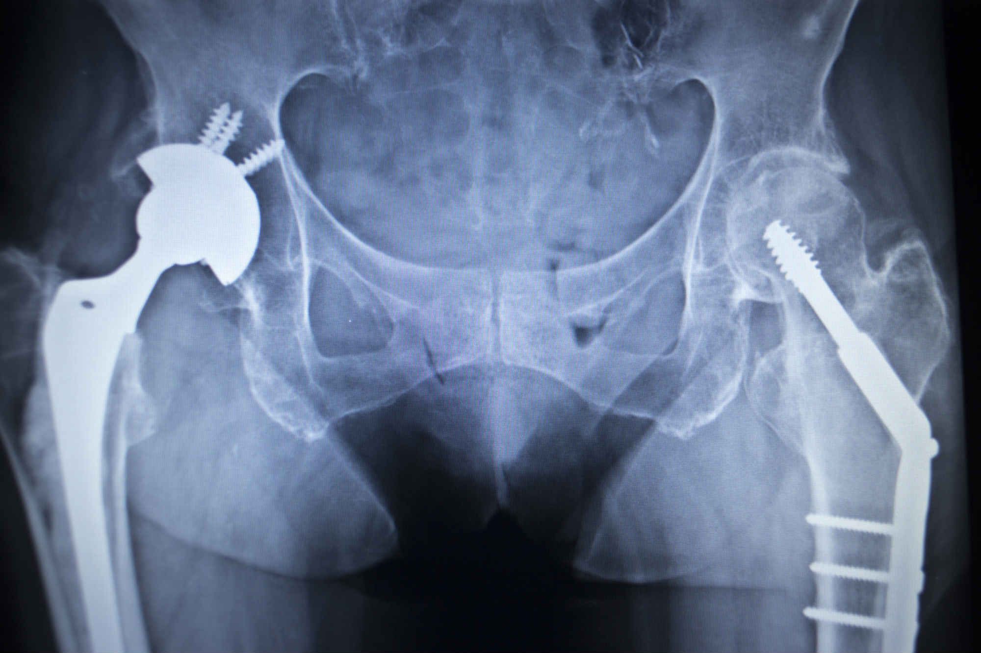 Major Device Complications Alleged in DePuy ASR Hip Replacement Lawsuit