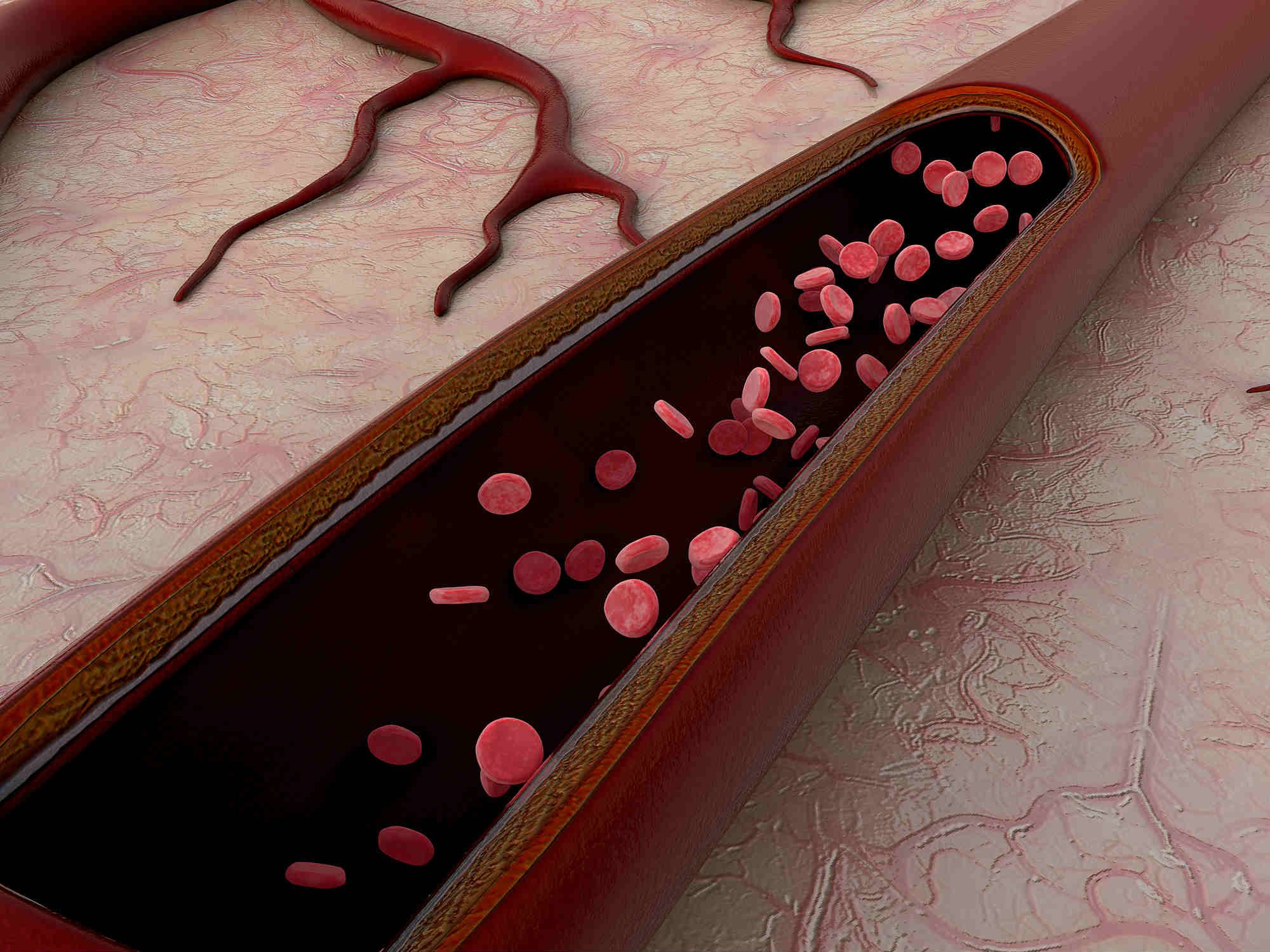 Growing Cook Medical MDL Alleges Device Complications after IVC Filter ...