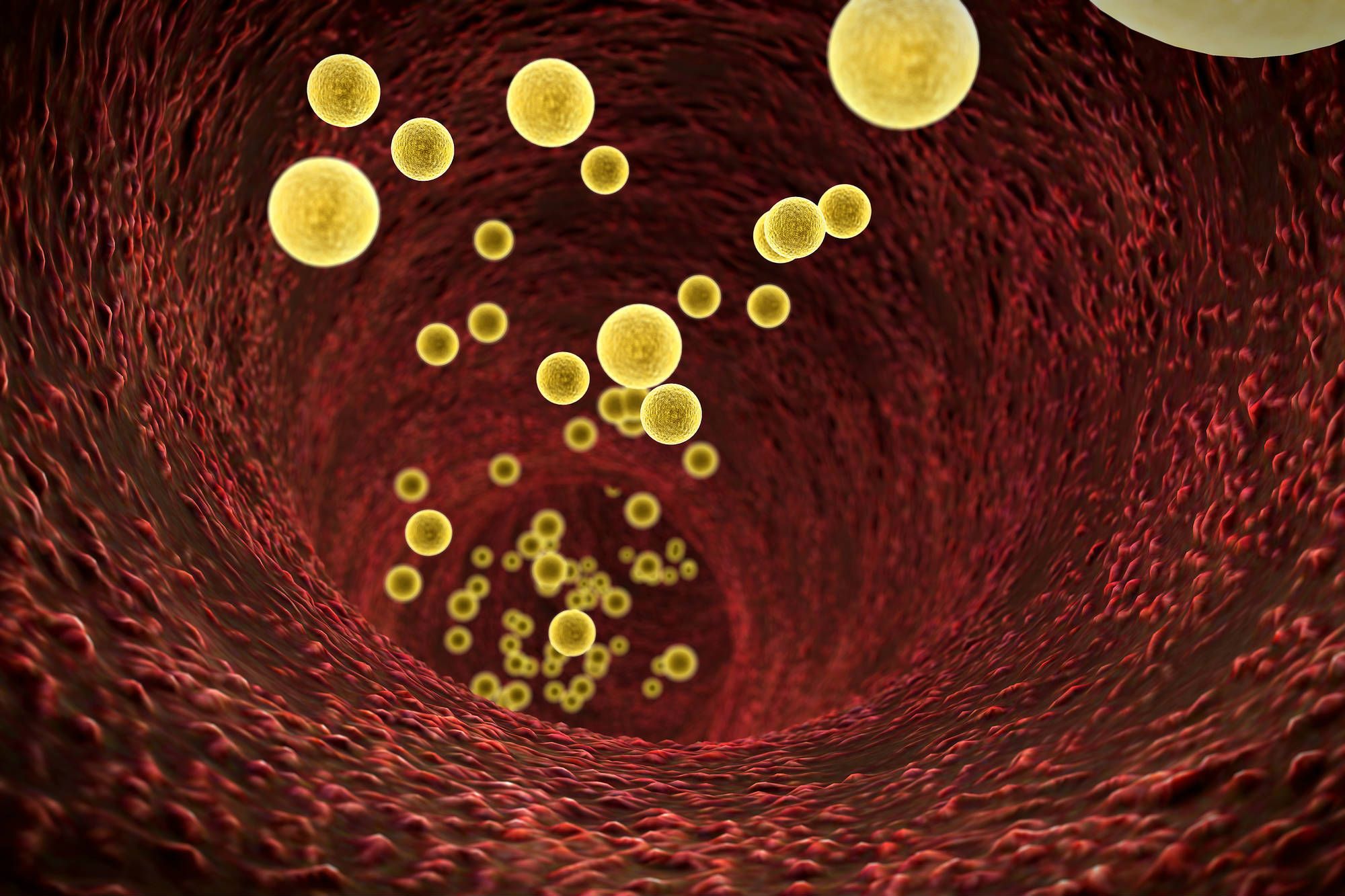 Man Suffers Acute Pulmonary Embolism After Clot Filter Implantation