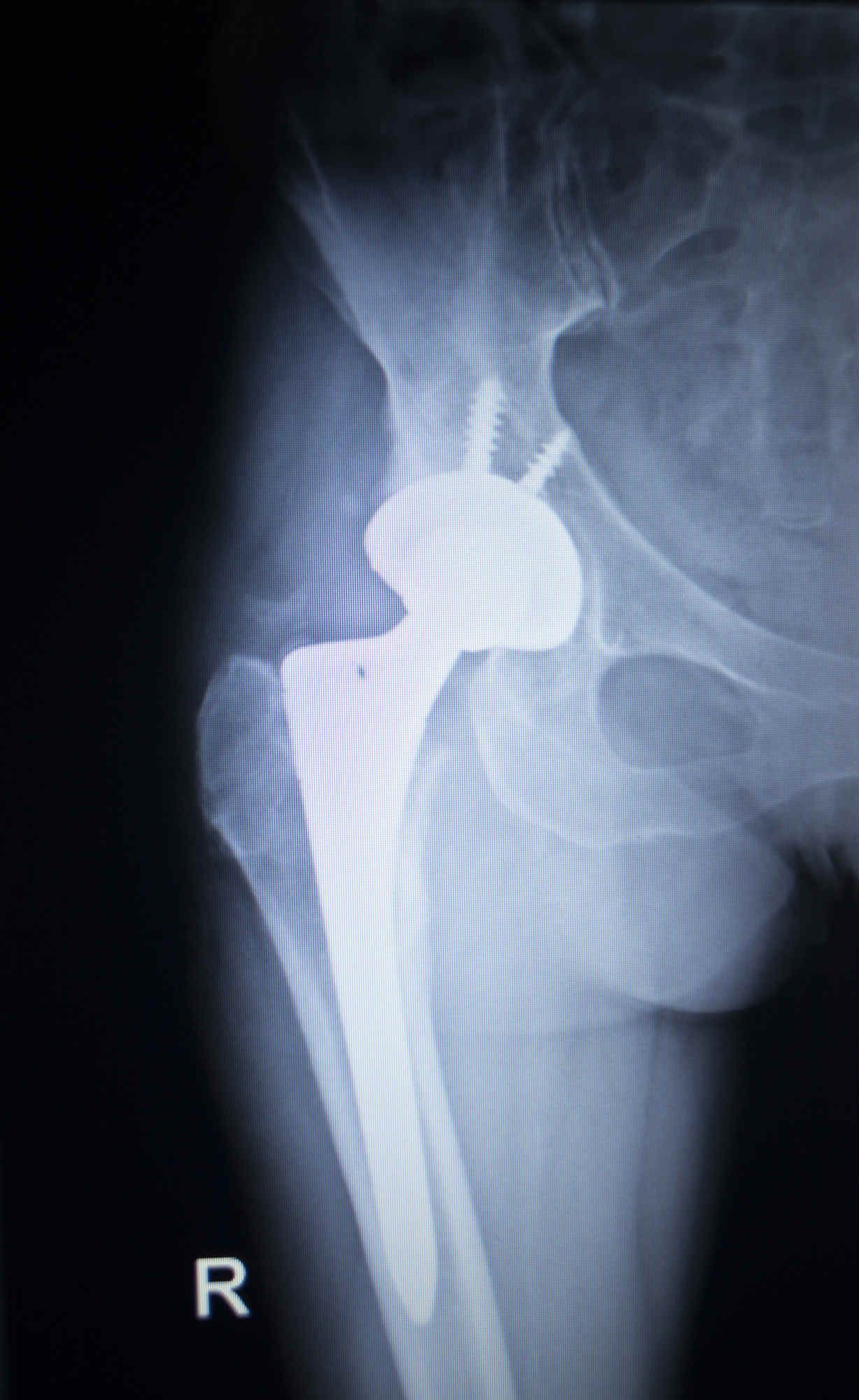DePuy Pinnacle Hip Implant Lawsuit Claims Hip Replacement Releases ...