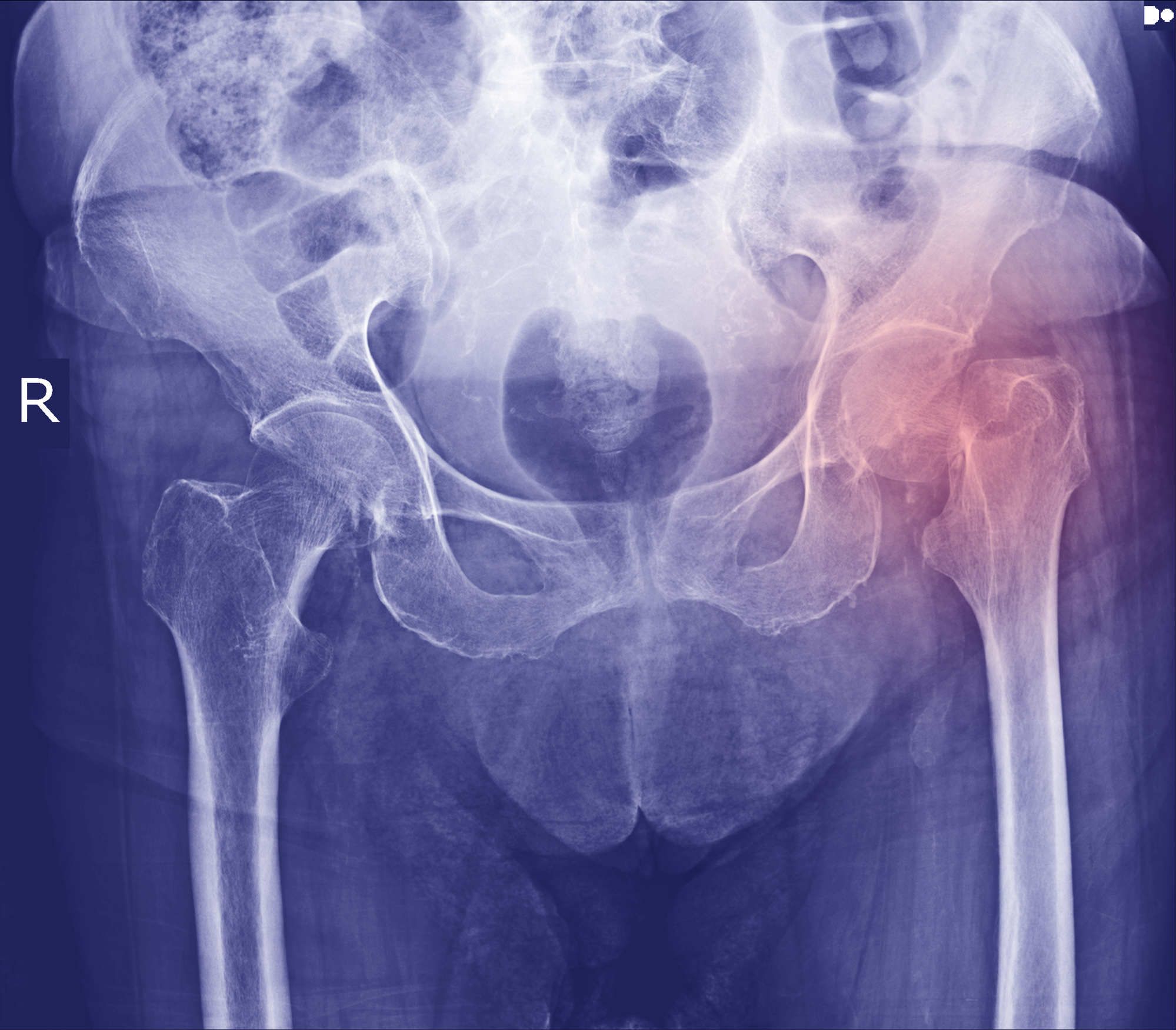 DePuy ASR Metal On Metal Hip Replacement Allegedly Prone To Failure