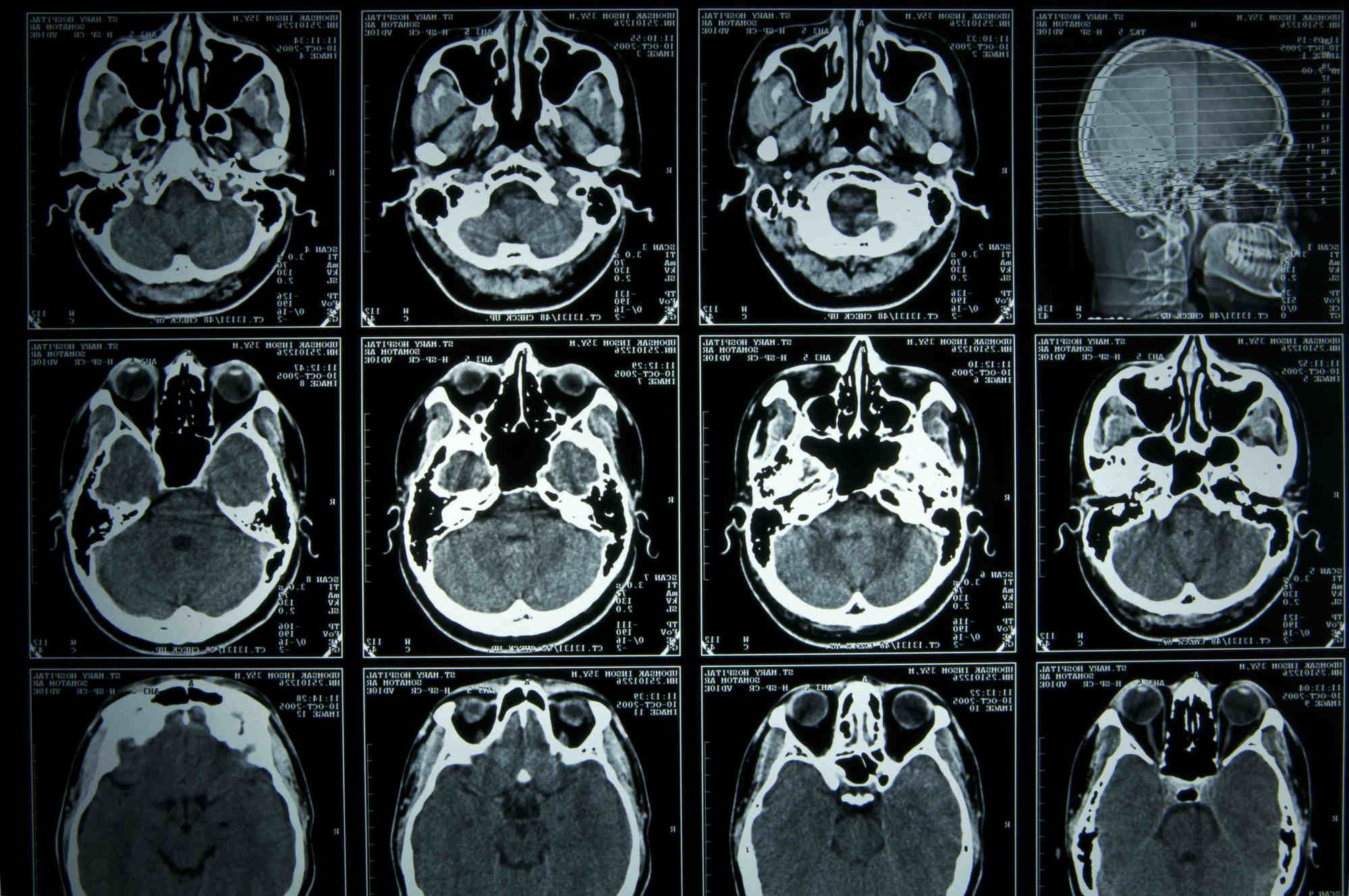 Gadolinium Brain Deposits Prompt FDA Recommendations and Call for Research