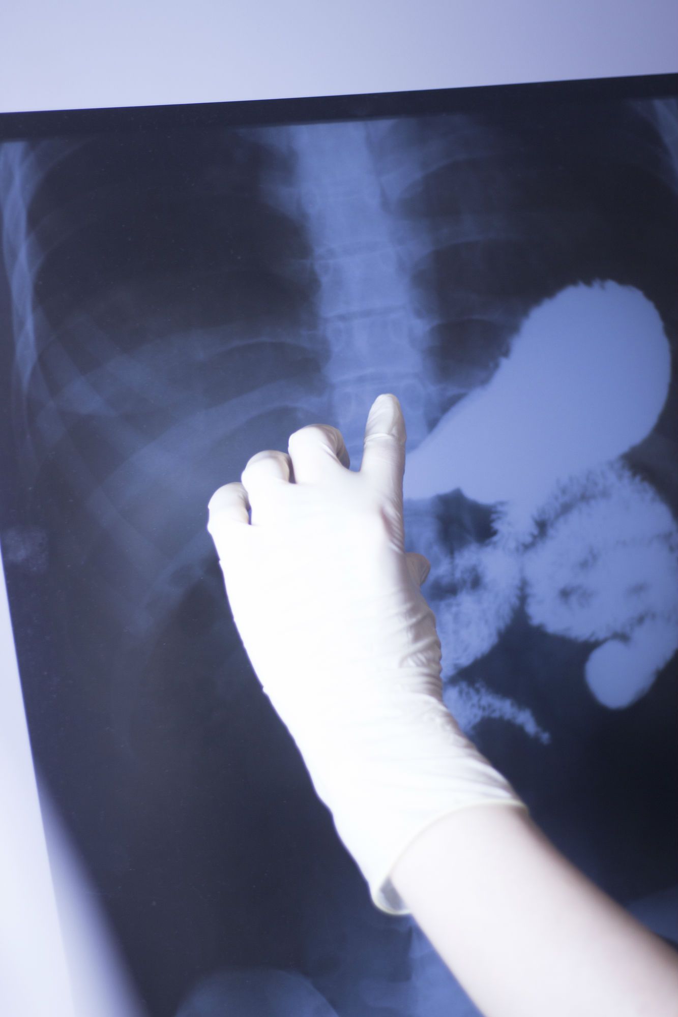 Patients Might Be Affected by ASR Hip Recall