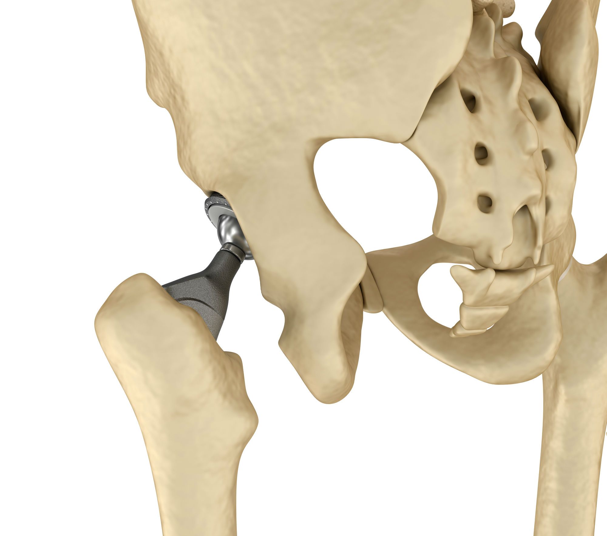 Patients in MDL Allege Problems with DePuy ASR Hip Replacement