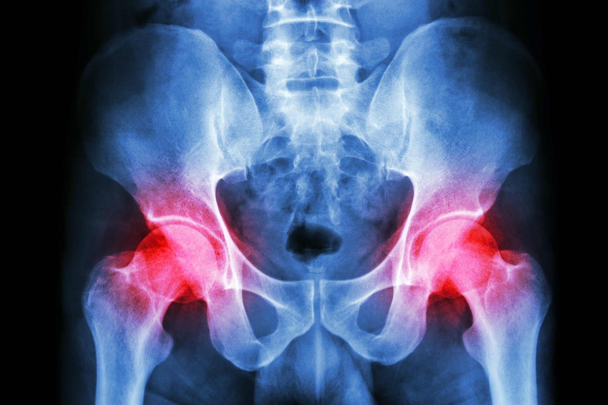 Biomet Hip Lawsuit Filed by Nevada Woman