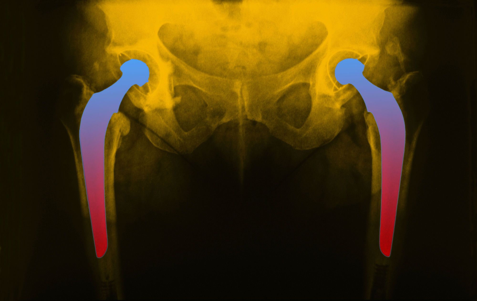 New Biomet Hip Lawsuit Filed Over Major Complications