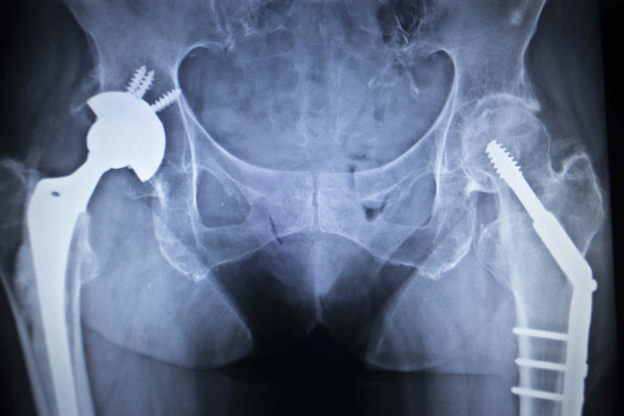 Metal-on-Metal Hip Implant Lawsuit Filed Over Serious Complications