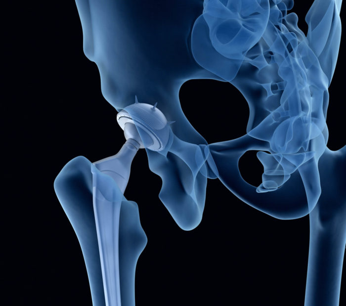 Man Files Pinnacle Hip Implant Lawsuit over Severe Adverse Side Effects