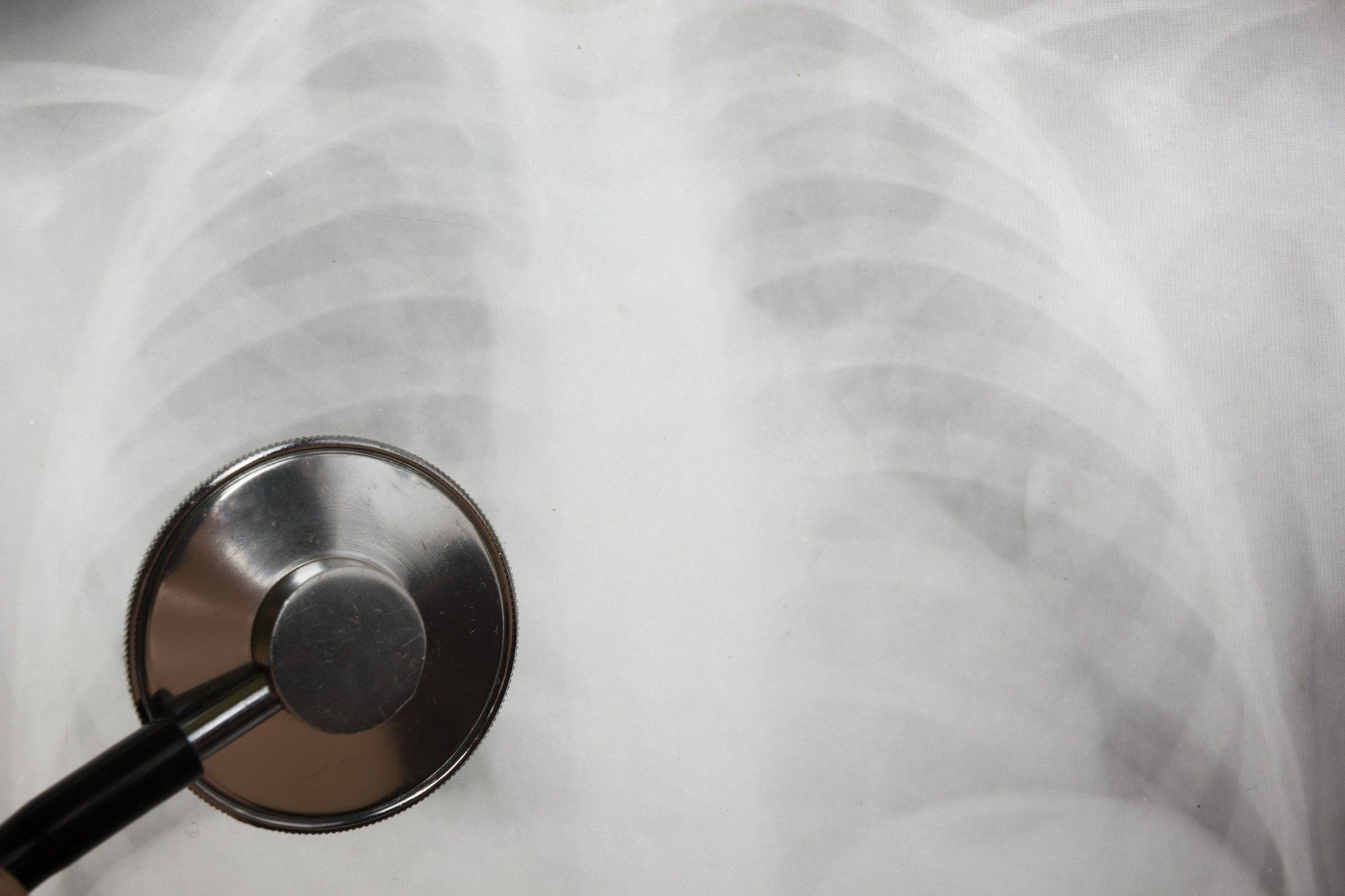 IVC Filter Perforation Rates Extremely High Among Bard Products ...