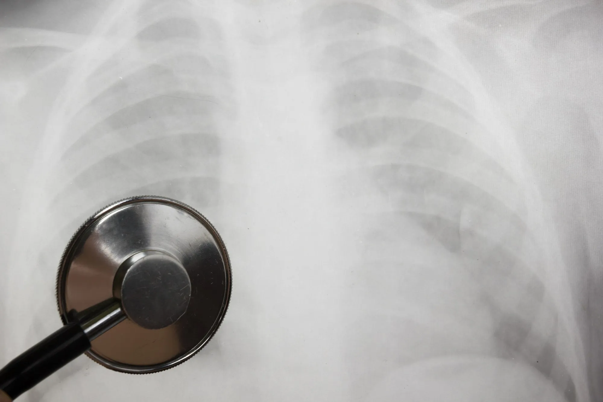 IVC Filter Perforation Rates Extremely High Among Bard Products ...