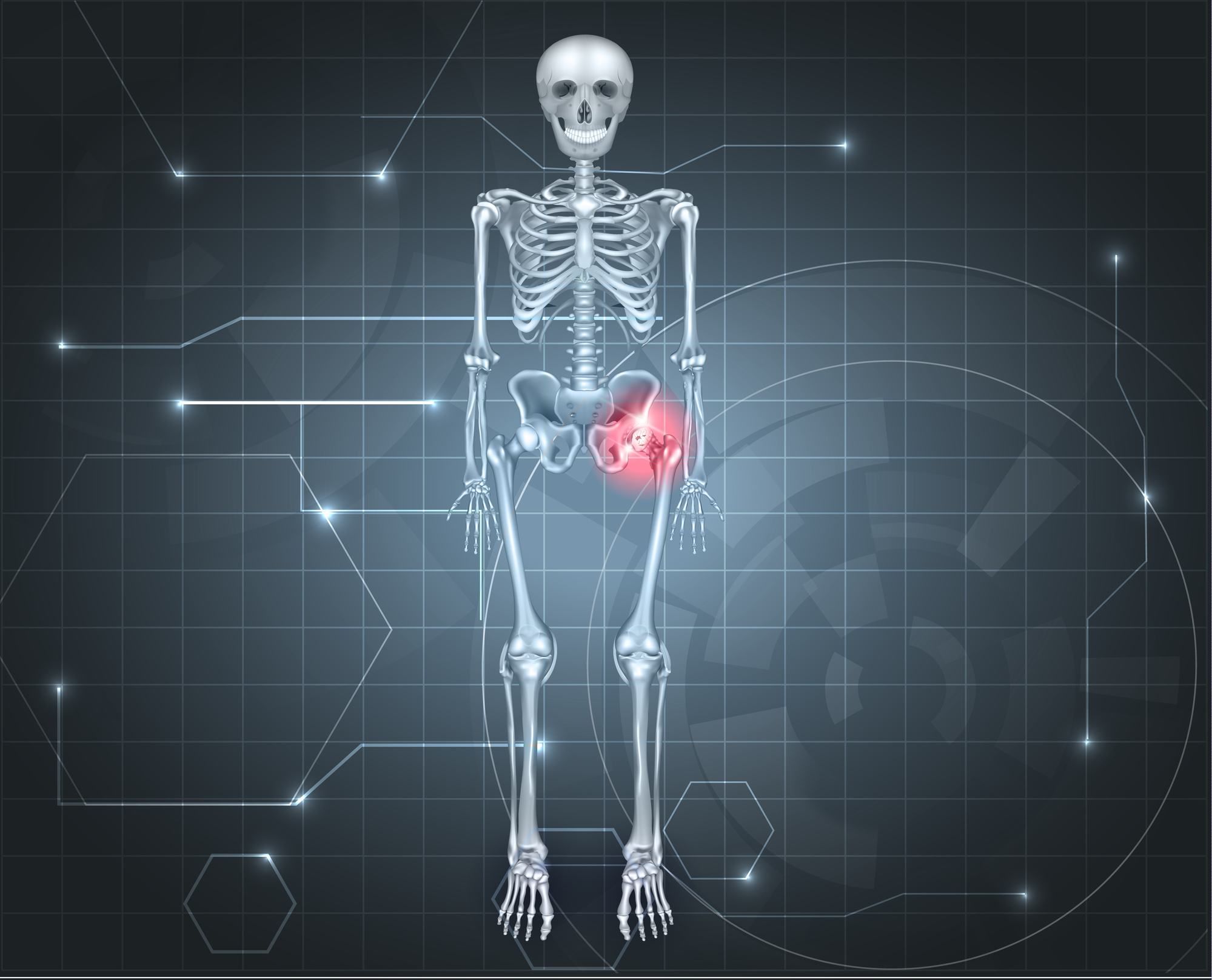 Numerous DePuy ASR Patients Needed Hip Revision Operation