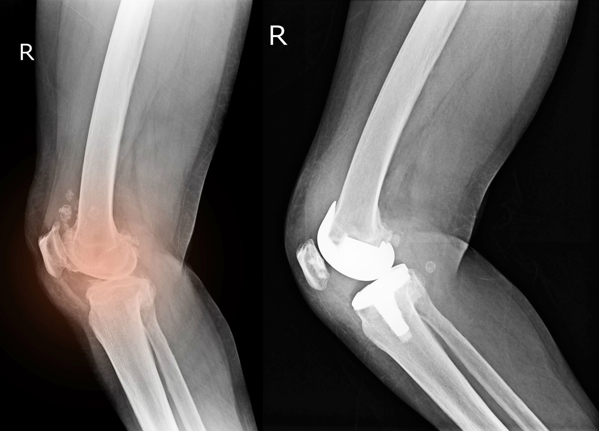 Zimmer Persona Tibial Plate Loosening Might Result in Knee Revision Surgery