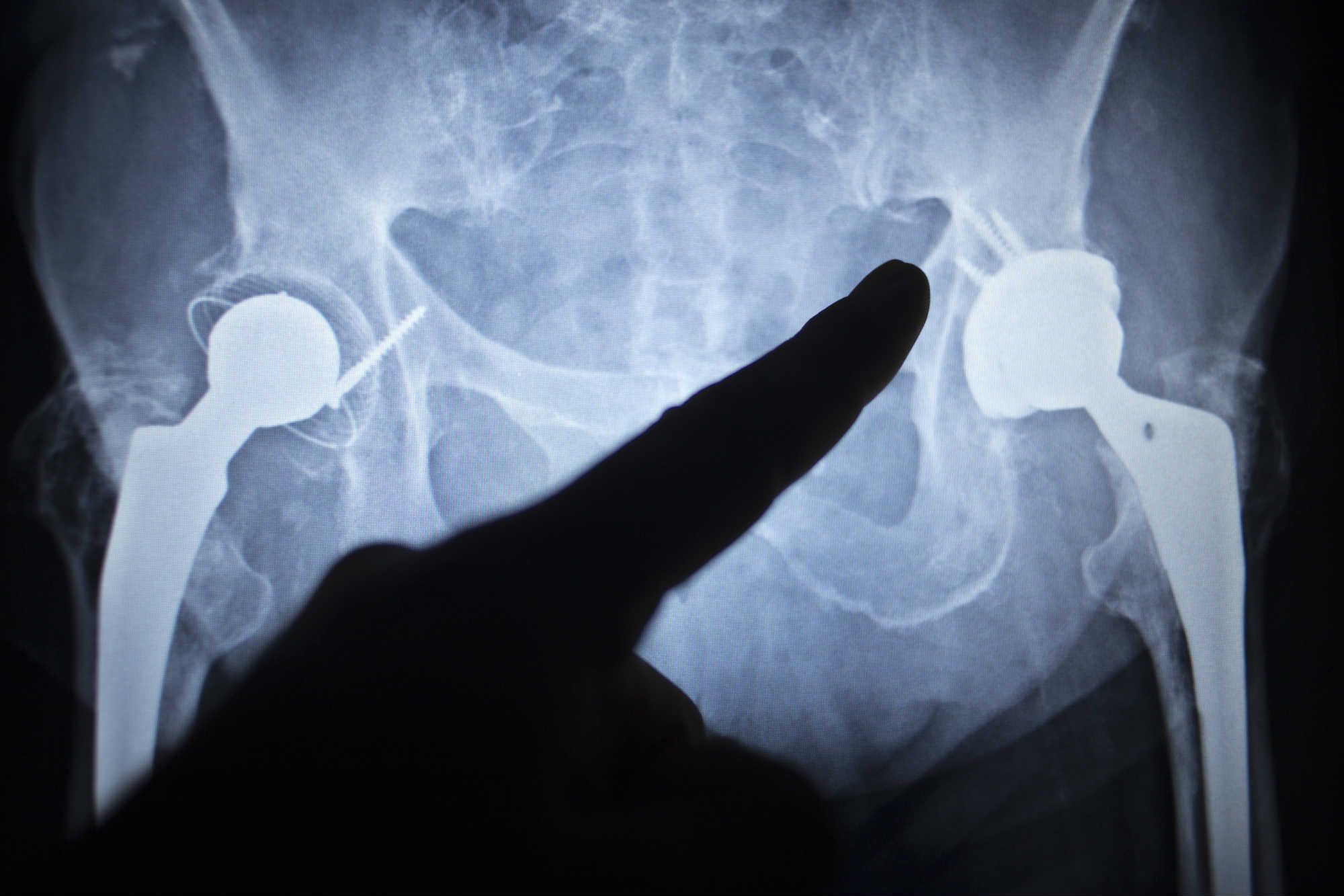 Concerns About Metal-on-Metal Hip Implants: Failures, Complications