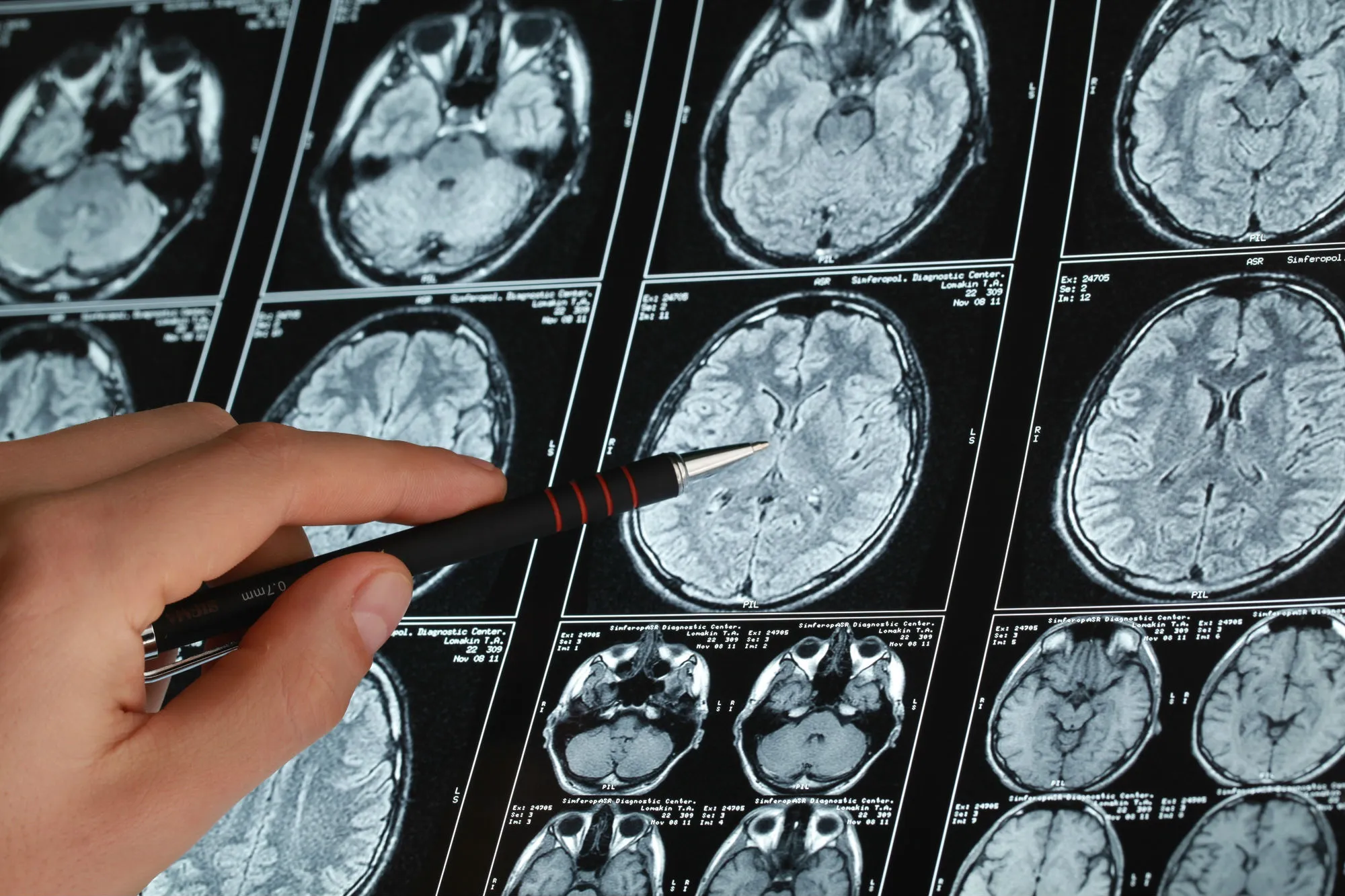 Dilantin Study Suggests Long-Term Use May Cause Focal Cerebral Atrophy