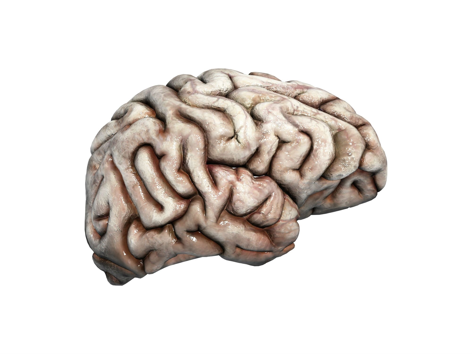 What is Intracranial Hypertension?