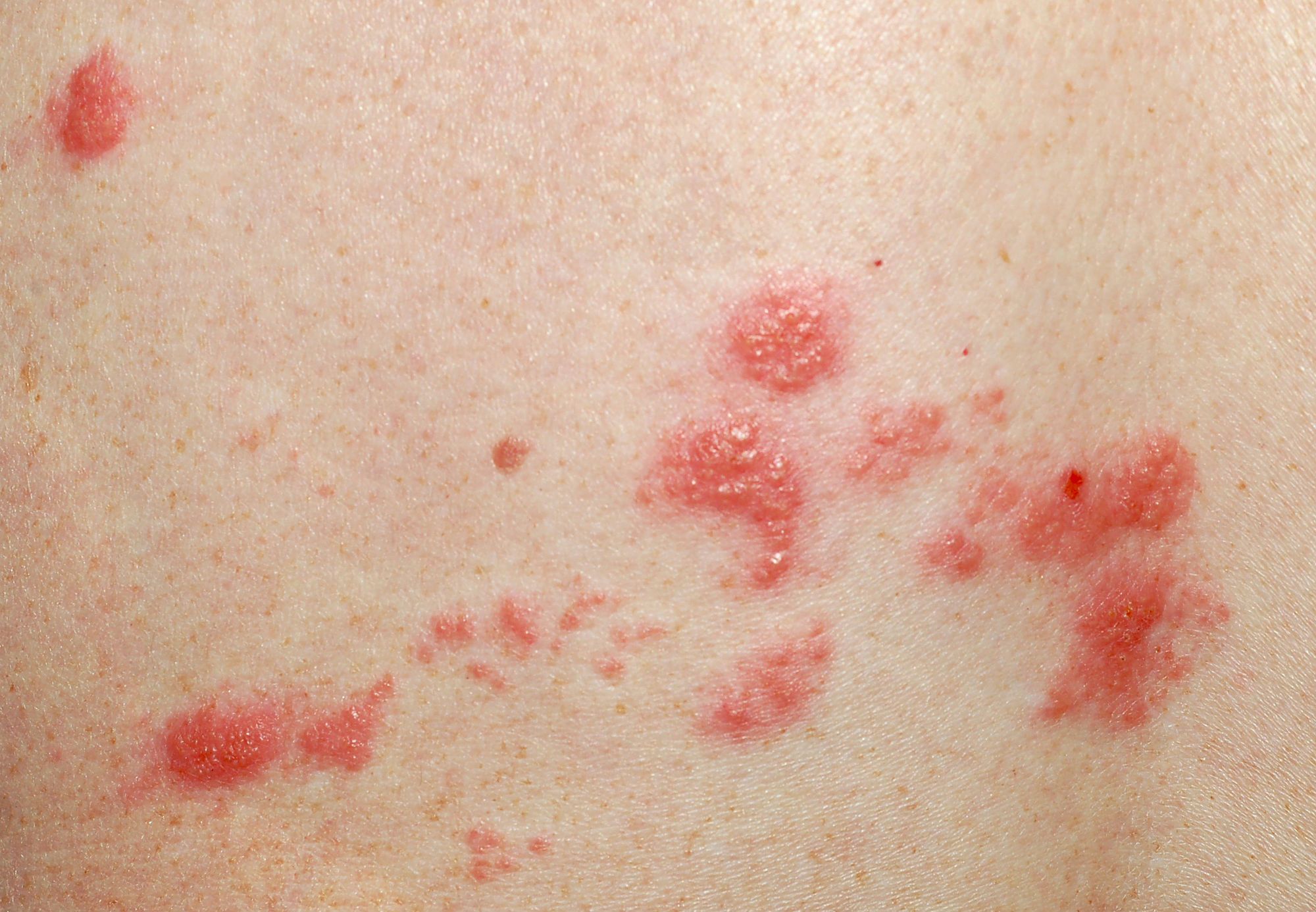 Can You Get Shingles After Being Vaccinated?