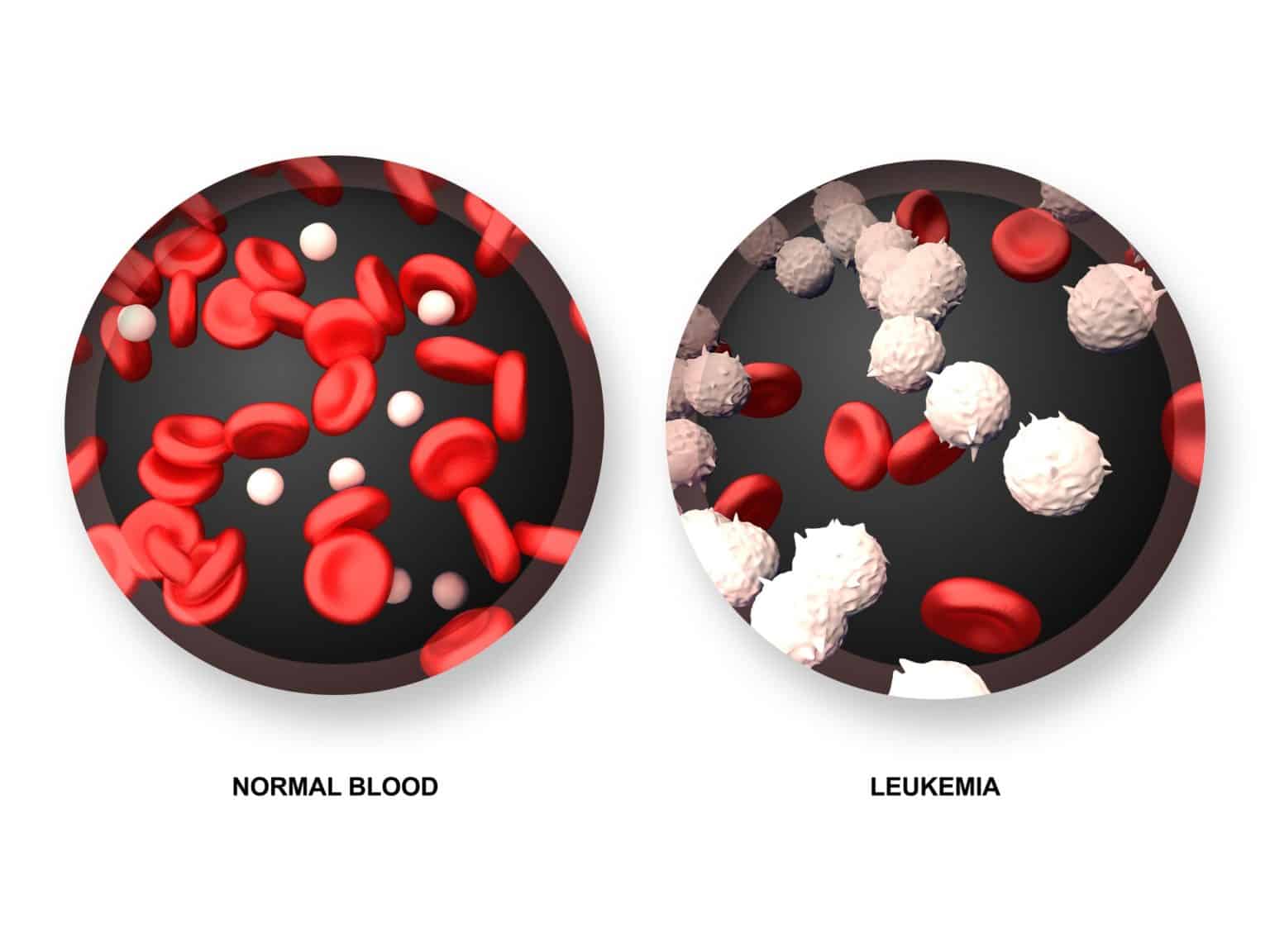 What Are the Stages of Chronic Lymphocytic Leukemia? - Top Class Actions