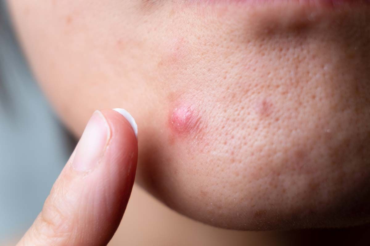 Johnson & Johnson class action alleges benzoyl peroxide acne products ...